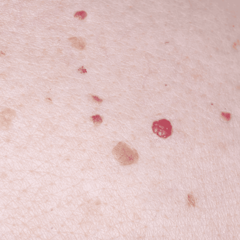 Uklanjanje angioma radiotalasima I Dermatološka ordinacija DIVA