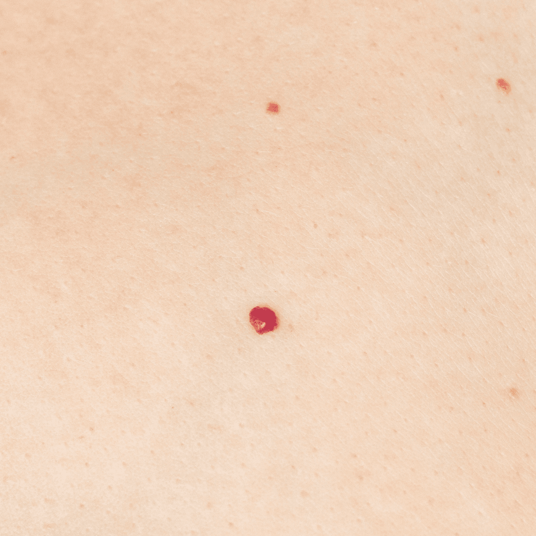Uklanjanje angioma radiotalasima I Dermatološka ordinacija DIVA
